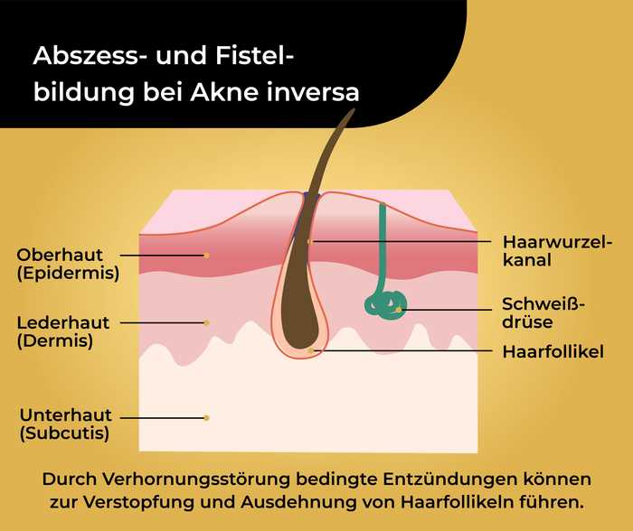 Immer Wiederkehrende Abszesse Ursachen Akne