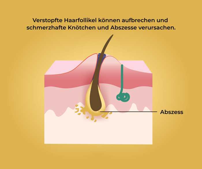 Immer Wiederkehrende Abszesse Ursachen Akne