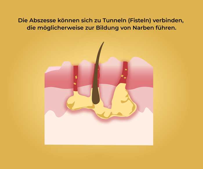 Immer Wiederkehrende Abszesse Ursachen Akne